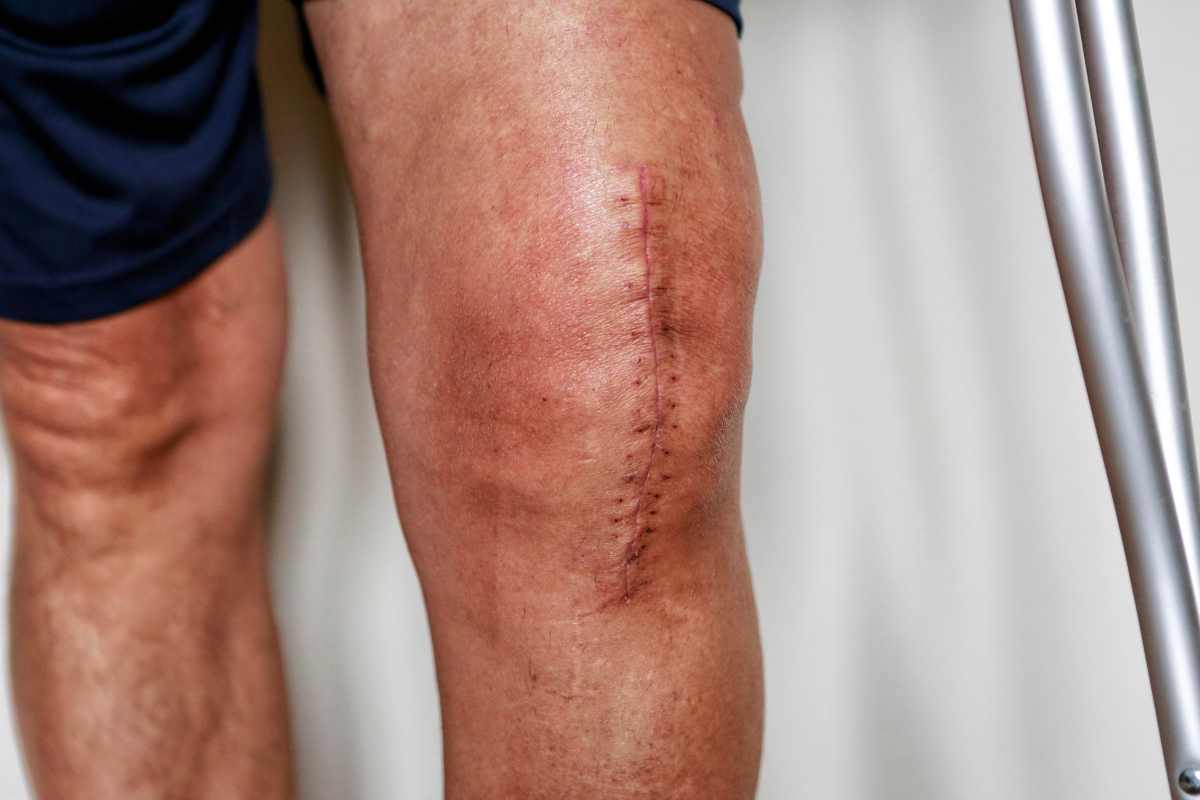 7 Long-term Benefits of Knee Replacement Surgery | Pinnacle Orthopaedics